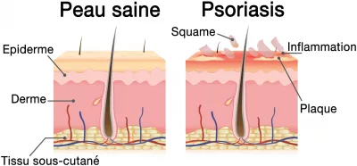 Psoriasis - Lydie Bonnet